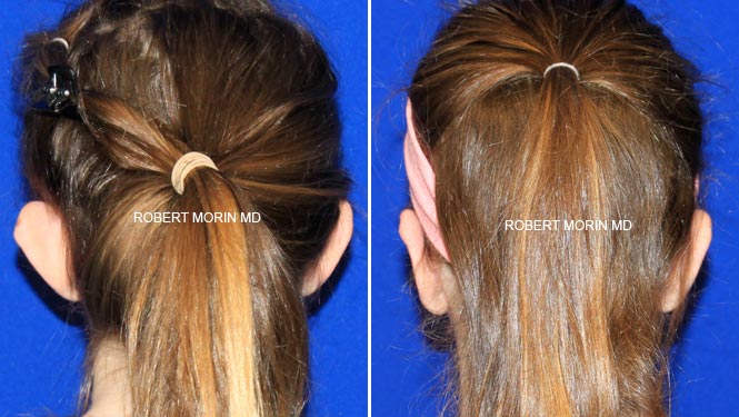Ear Reconstruction Photo Gallery New Jersey | Ear Surgery Hackensack
