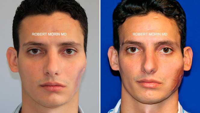 Ear Reconstruction Photo Gallery New Jersey | Ear Surgery Hackensack