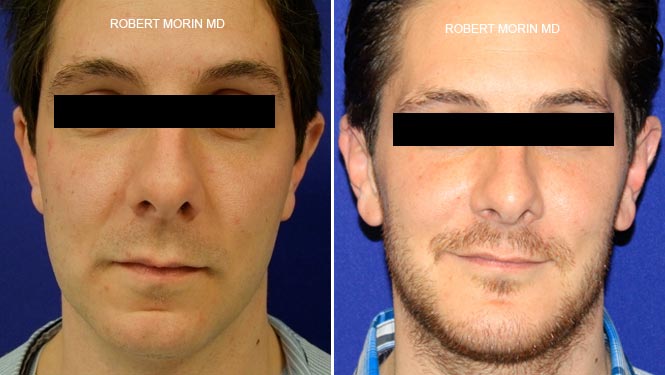 Chin Surgery Photo Gallery NYC | Genioplasty Hackensack, NJ