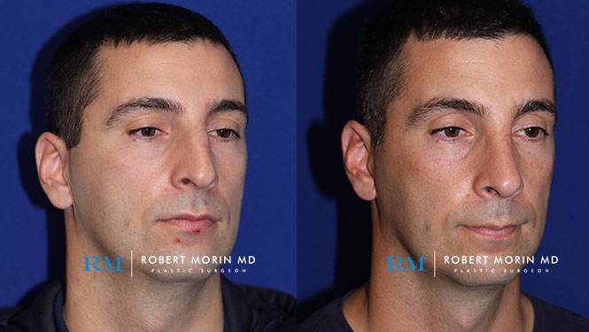 Rhinoplasty Before and After Photos