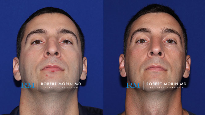 Rhinoplasty Before and After Photos