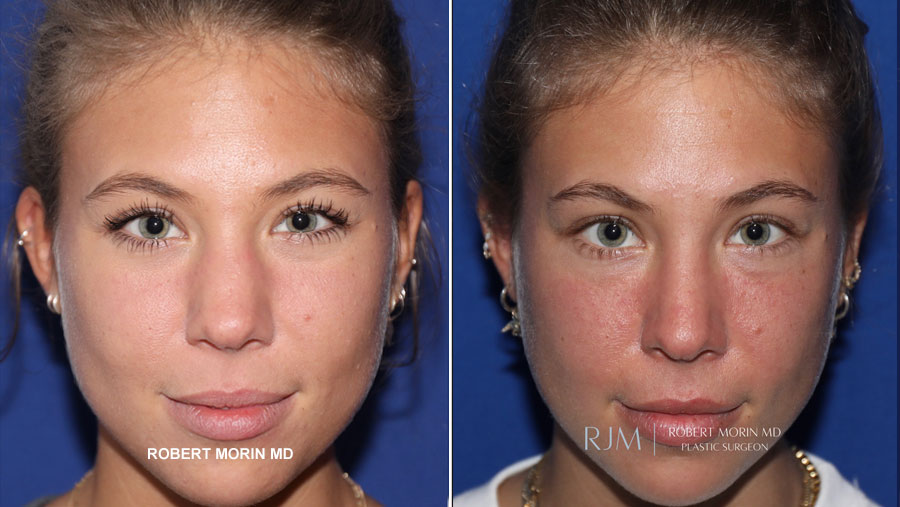 Rhinoplasty Before and After Photos