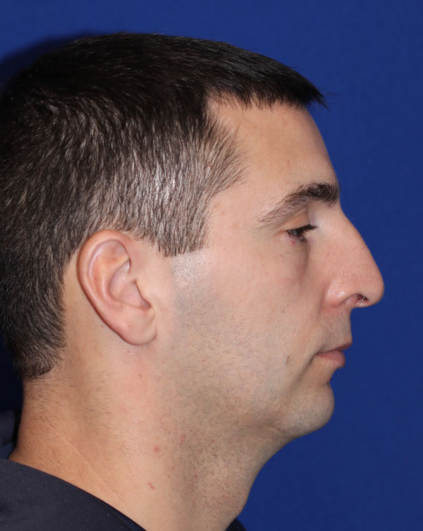 NJ Rhinoplasty Surgeon | Dr. Robert Morin