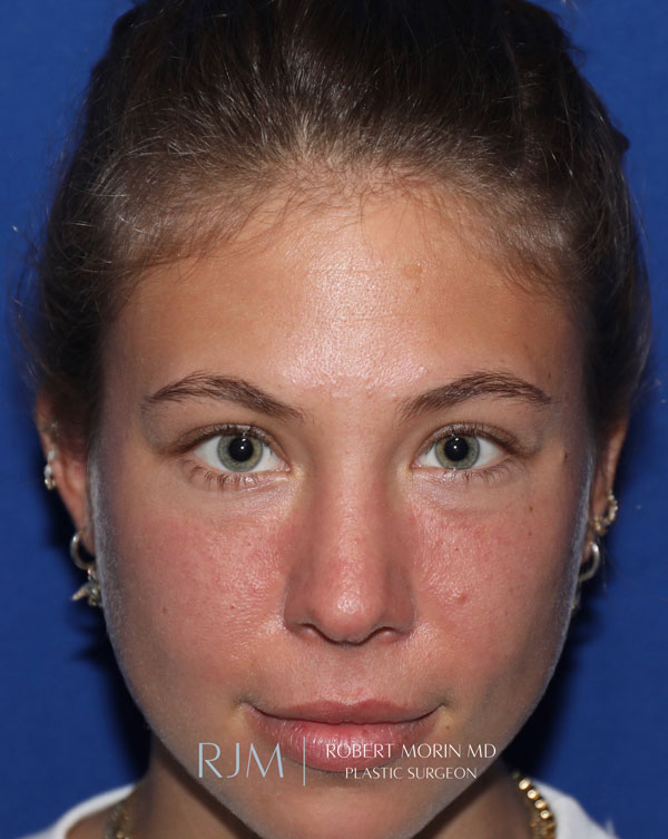 NJ Rhinoplasty Surgeon | Dr. Robert Morin