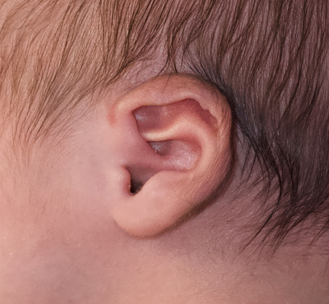 EarWell Infant Ear Molding NYC | Newborn Infant Reshaping System